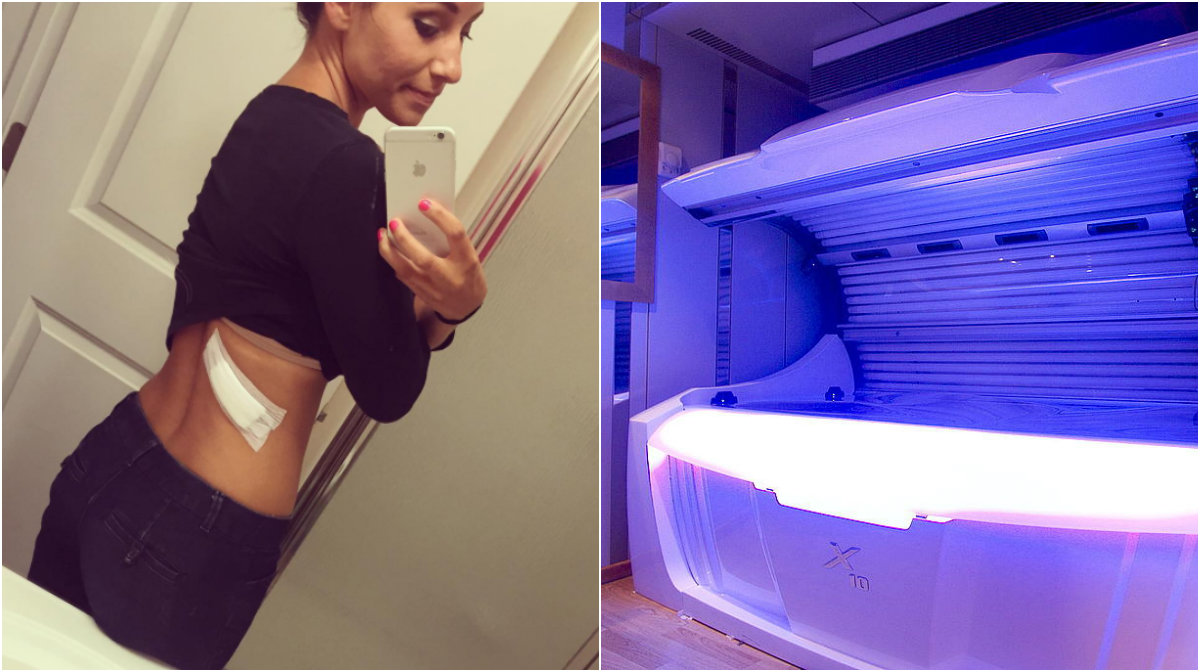 Solade solarium varje dag som tonåring – fick cancer när hon var 25