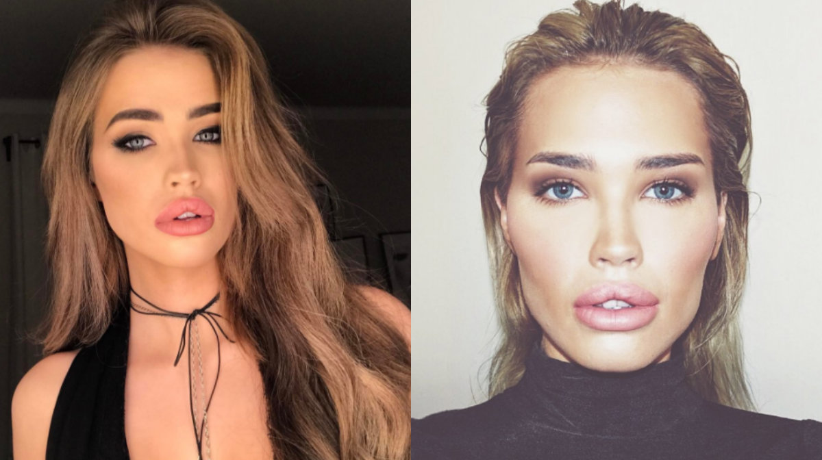 Isabella Jedler tog bort sina fillers – resultatet!