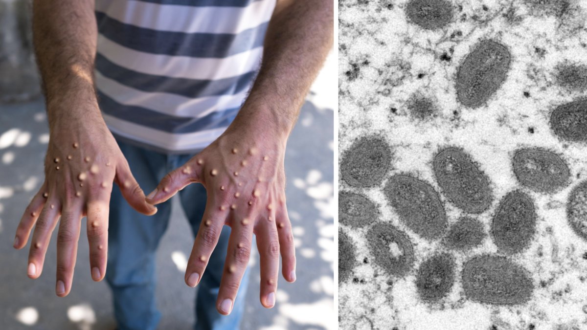 Sverige har fått vaccin mot apkoppor – här är städerna som prioriteras